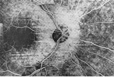Figure I From Choroidal Folds In Association With Papilloedema