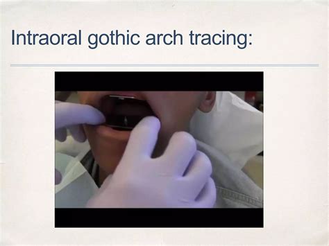 Gothic Arch Tracing Pptx