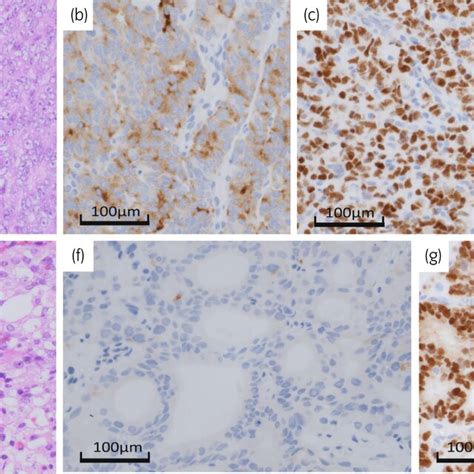 Histopathological Findings Of Specimens Showing Large‐cell