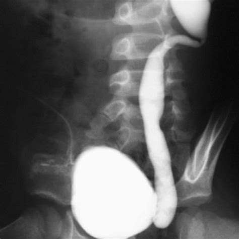 Follow Up Voiding Cystourethrogram Normal Appearance Of The Urethra Download Scientific