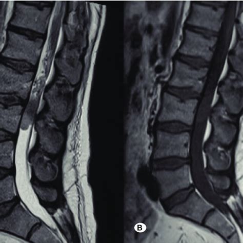 Lumbar Magnetic Resonance Imaging Shows The Lesion Was Hypointense On