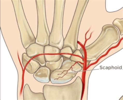 질병 손목뼈 주상골 골절scaphoid Fracture