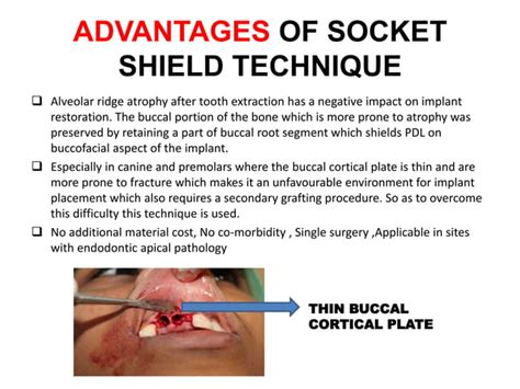 Socket Shield Technique Ppt