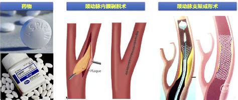 左乔教授：稳而有容，经桡颈动脉支架成形术技术解析与病例分享 脑医汇