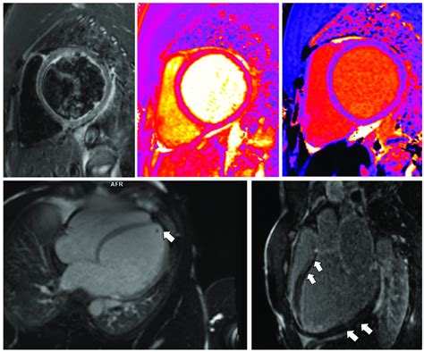 cardiac magnetic resonance cmr findings in patient 2 top panel