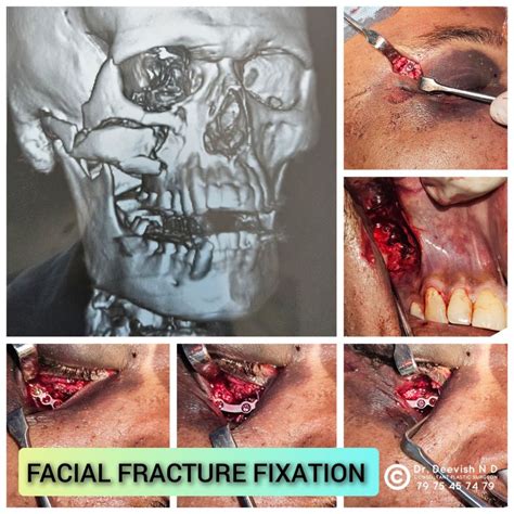 Facialfracture Zygomafracture Orif Drdeevishnd Healisornr Plasticsurgery Dr Deevish