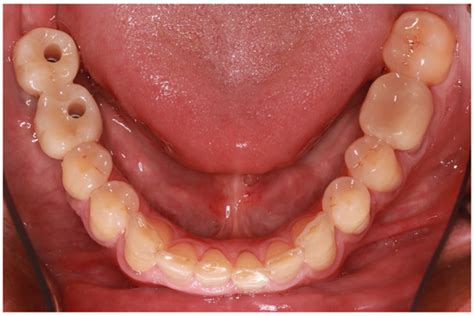 Endocrown Restoration For An Endodontically Treated Molar A Step By