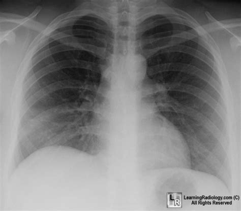 Learningradiology Right Middle Lobe Atelectasis Rml