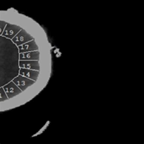 Cortical Cerebral Blood Flow Measurement—one Example The Figure