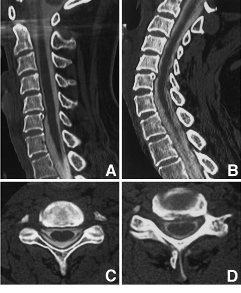Case 8 Series Of Sagittal A B And Axial Images C D Of Dynamic