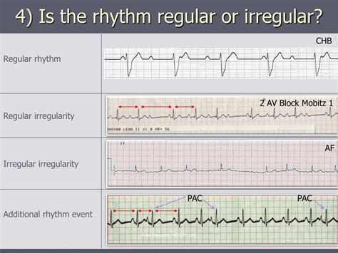 Regular Vs Irregular Heart Rhythm At May Myers Blog