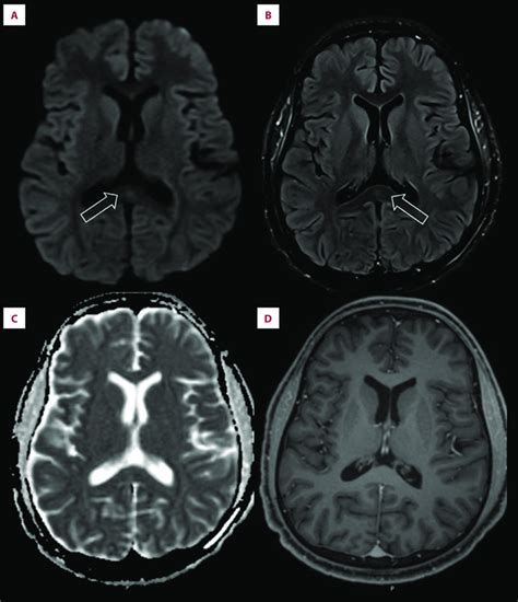 Brain Magnetic Resonance Imaging Mri On Admission Diffusion Weighted