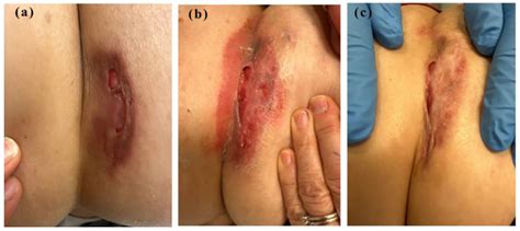Chronic Non Healing Ulcer Reveals Pyoderma Gangrenosum A Case Report Pmc