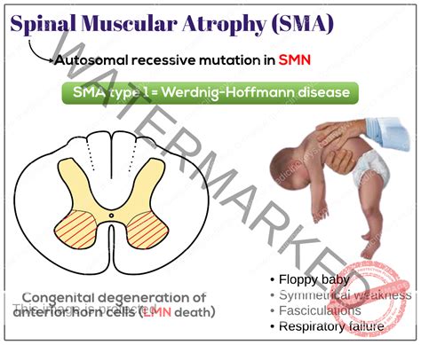 Everything You Need To Know About Spinal Muscular Atr
