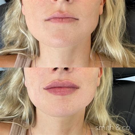 Natural Lip Fillers Natural Lips Botox Fillers Lip Fillers