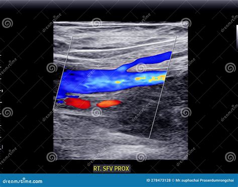 Color Doppler Ultrasound Determination In Deep Vein Thrombosis Patients