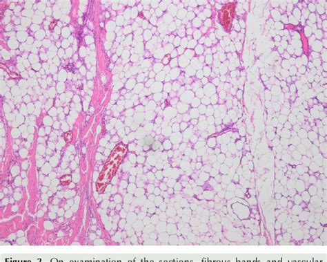 Pdf Tracheal Lipoma Mimicking Asthma Semantic Scholar