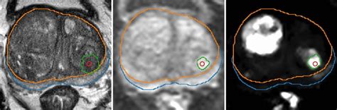 Automatic Lesion Segmentation For A Prostatex Patient In Sequences