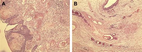 A Histopathological Examination Of The Polypoid Fragments Reveals Download Scientific Diagram