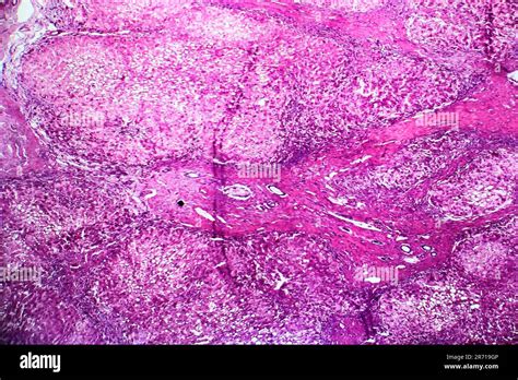 Histopathology Of Alcoholic Hepatitis Light Micrograph Photo Under