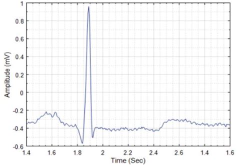 Figure 1 From Detection Of Electrocardiogram Qrs Complex Based On