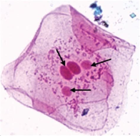 Buccal Epithelial With Binucleated Cell And Two Micronuclei Download Scientific Diagram