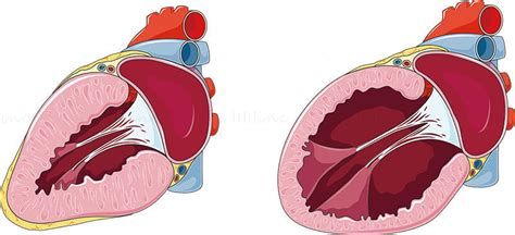 Left Ventricular Remodeling Following Myocardial Infarction Vector