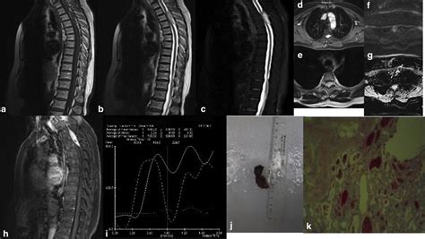 Case 2 Sagittal T1 Weighted A Sagittal T2 Weighted B Sagittal