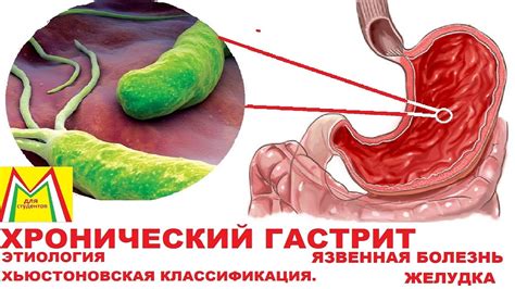 ХРОНИЧЕСКИЙ ГАСТРИТ и ЯЗВА ЖЕЛУДКА Этиология Классификация Youtube