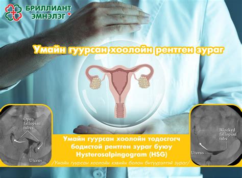Умайн гуурсан хоолойн рентген зураг 🔶Умайн гуурсан хоолойн тодосгогч бодистой рентген зураг