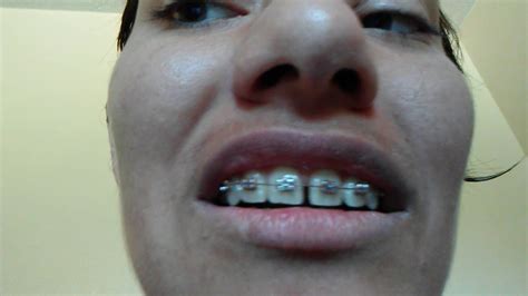 Bite Block Problems Still Doing Great Youtube