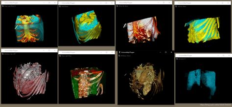 kiss dicom viewer 体渲染插件（利用vtk volume 实现体渲染） vtk 小蚂蚁 csdn博客
