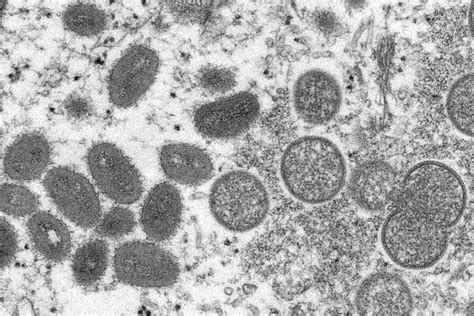 Monkeypox Likely Spread By Sex At Two Raves In Europe Expert The