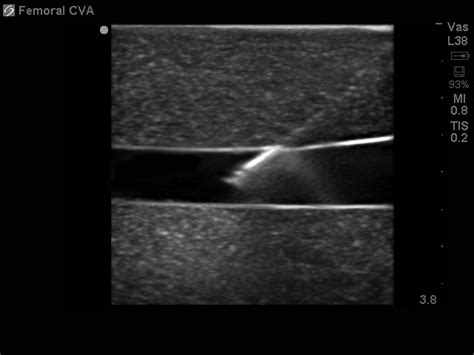 Leg Femoral And Saphenous Vein Venous Access Ultrasound Training Model With Dvt Option