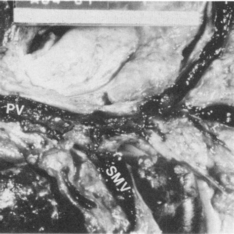 Diffuse Venous Thrombosis Of The Portal System In A 65 Yearold Man With