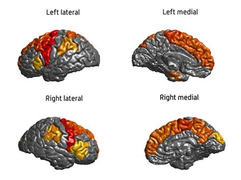 Epilepsy Linked To Brain Volume And Thickness Differences