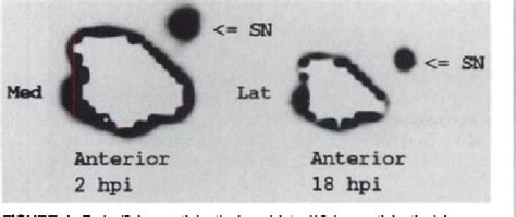 Figure 3 From Impact Of Lymphoscintigraphy On Sentinel Node Identification With Technetium 99m