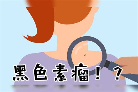黑色素瘤危害健康皮肤长痣要注意3个特征辨别好坏 皮肤 好坏 危害
