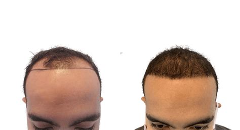 Patient 588 Hair Transplants Before And After Photos Houston Tx
