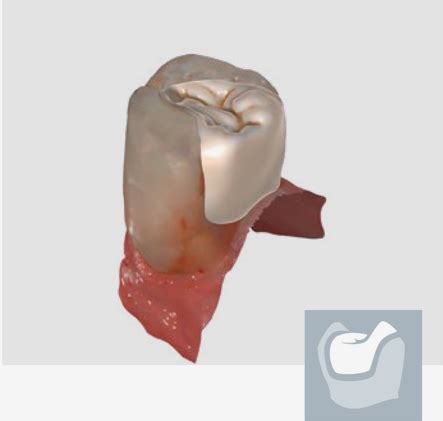 Exocad Shining Ddental Com