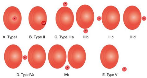 Sa1419 A Modified Classification Of Periampullary Diverticulum And Its