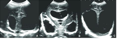 Four Day Old Neonate Affected By Toxoplasmosis And Undergoing The