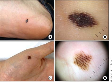 Superficial Spreading Melanoma On The Ankle Download