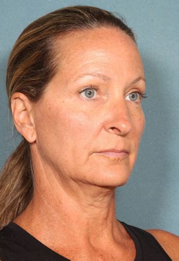 Non Invasive Skin Resurfacing Naples Estero Marco Island