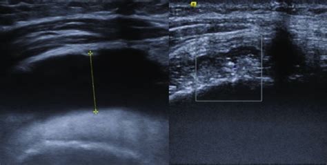 Suprapatellar Effusion Ultrasound