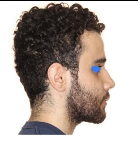 Beforeafter Upper Jaw Surgery Rplasticsurgery
