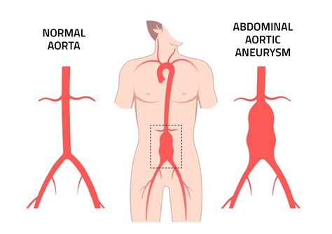 Endovascular Aneurysm Repair Evar For Abdominal Aortic Aneurysms