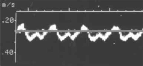 V024 Normal Venous Doppler Waveforms Pictures Flashcards Quizlet