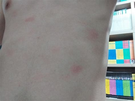 콜린성 두드러기 맞을까요 지식in