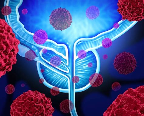 Asco Guideline Neoadjuvant Chemotherapy For Ovarian Cancer Updated Medipaper